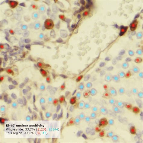 The Sample Ai Output Showing Nucleus Annotations And Overall Ki 67 Download Scientific Diagram