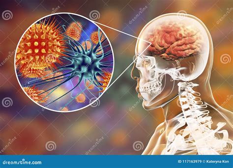 Viral Meningitis And Encephalitis Medical Concept Royalty Free