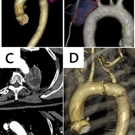 A B Preoperative 3 Dimensional Computed Tomography Angiography