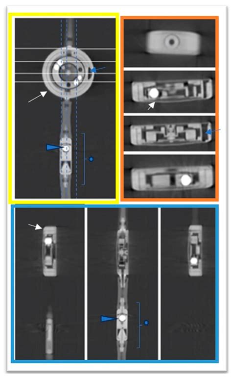 Three Dimensional Visualization Of Shunt Valves With Photon Counting Ct And Comparison To