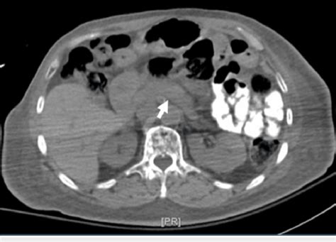 Axial Ct Scan Of The Abdomen Showing Normal Appearance Of The Pancreas