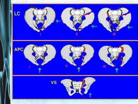 Pelvic Fracture Classification Pptx