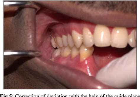 Figure 2 From Management Of A Hemimandibulectomy Patient Using A Guide Plane Prosthesis And A