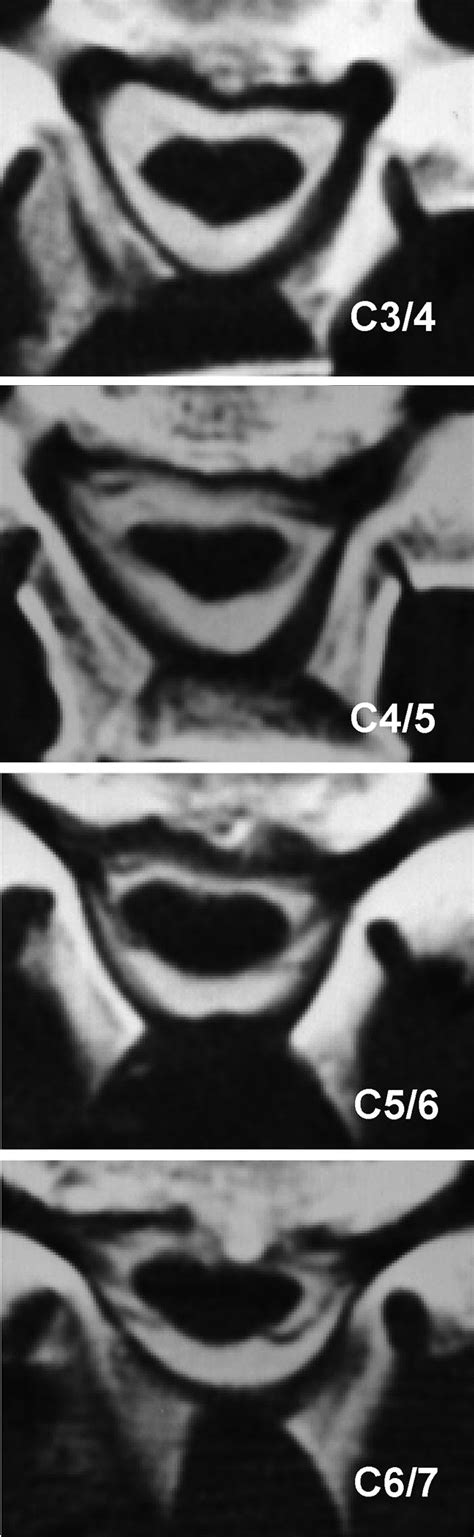 Postoperative Ct Myelograms Download Scientific Diagram