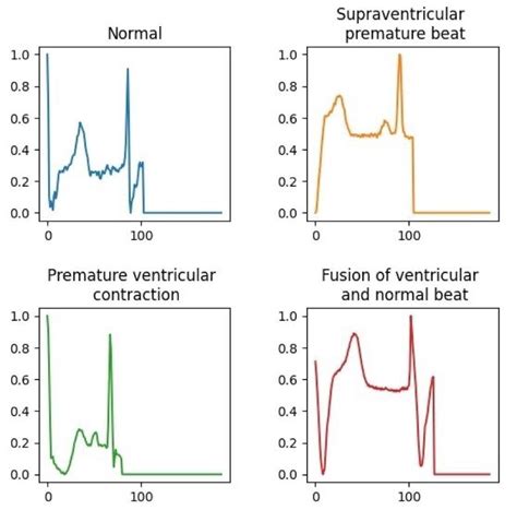 Xiangjun Ji On Linkedin Ai Ecg Rnn Lstm Machinelearning