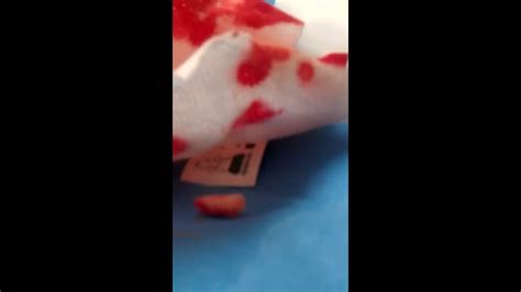 Cyst Removal YouTube