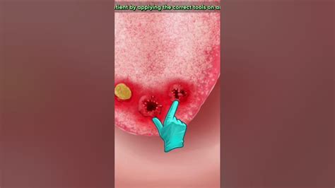 Toung Pus Treatment 3d Animation Jebha Jibhi Pus Youtube