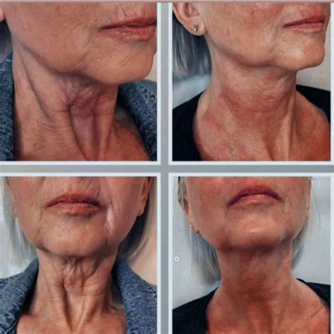 Nms Face Near Me Facial Toning Berkeley Worthy