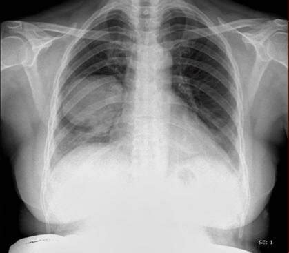 Chest X Ray Showing A Right Large Opacity Download Scientific Diagram