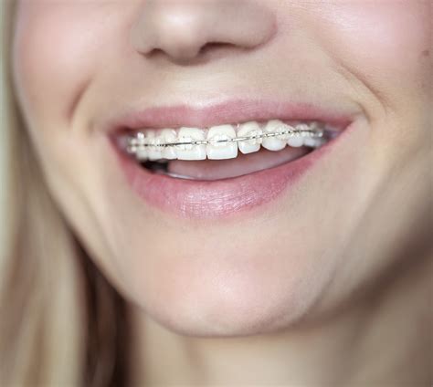 Ceramic Braces Aesthetic Clear Braces Yorkshire Orthodontics