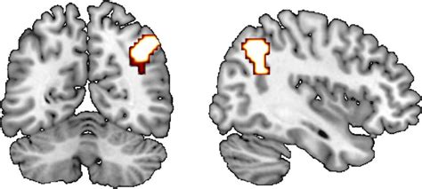 Right Angular Gyrus Mni X 39 Y −58 Z 50 Showed Increased