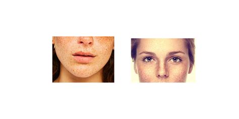 کک و مک چیست؟ چگونه درمان می شود؟ آکادمی احسان حسنانی