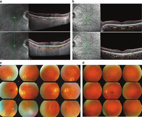 A Edi Oct Measurement Of Choroidal Thickness Top—horizontal And