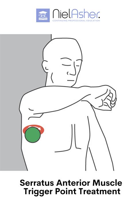 How To Treat A Trigger Point Subscapularis Artofit