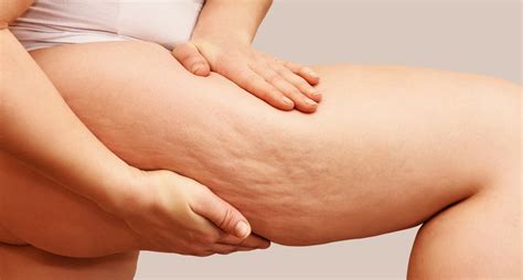Cellulite Causes Symptoms And Treatments