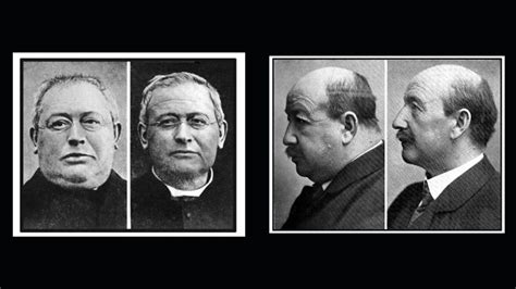 Myxedema Unraveling A Serious Symptom Of Untreated Hypothyroidism