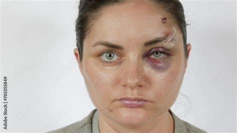 Large Real Bruise Hematoma Under The Eye Of A Young Woman Fresh Purple