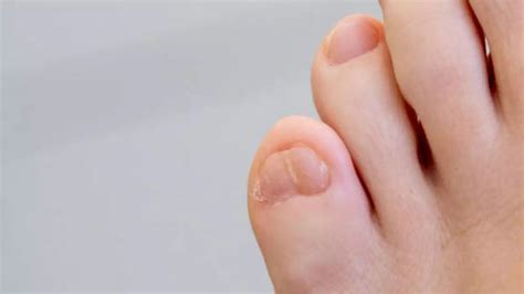 Cancer Symptoms In Nails Your Nail Colour Can Signal Cancer Risk Says