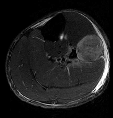 Compartment Syndrome Of The Leg Radsource