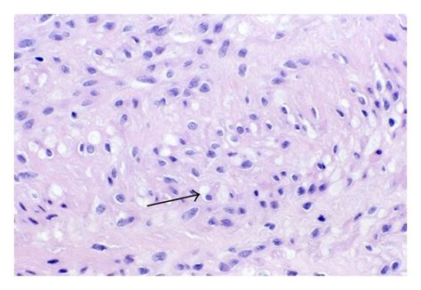 Vacuolization Of Myocytes In Phase 3 And 4 Fibroids Cytoplasmic