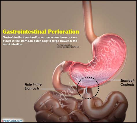 Gastrointestinal Perforation Causes Cajmil