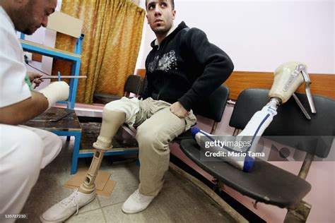 Hussein Mahdi Is Fitted For A Prosthetic At The Hospital For News