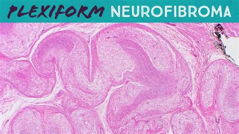 Plexiform Neurofibroma Histology