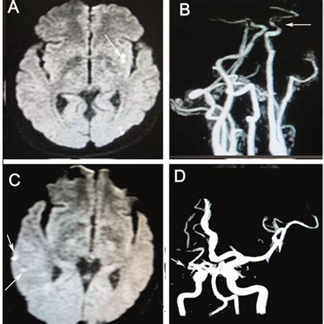 Diffusion Weighted Imaging DWI And Vascular Imaging Of Acute Download Scientific Diagram