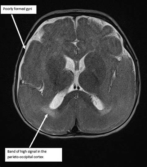 Lissencephaly Ultrasound