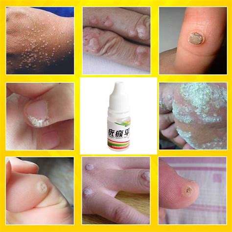 Photo Gallery Of Warts On Different Body Parts