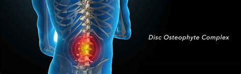 Disc Osteophyte Complex Bonati Spine Institute