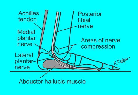 Medial Plantar Nerve Entrapment