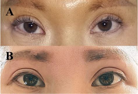 A Preoperative Bilateral Moderate Upper Eyelid Depression And B