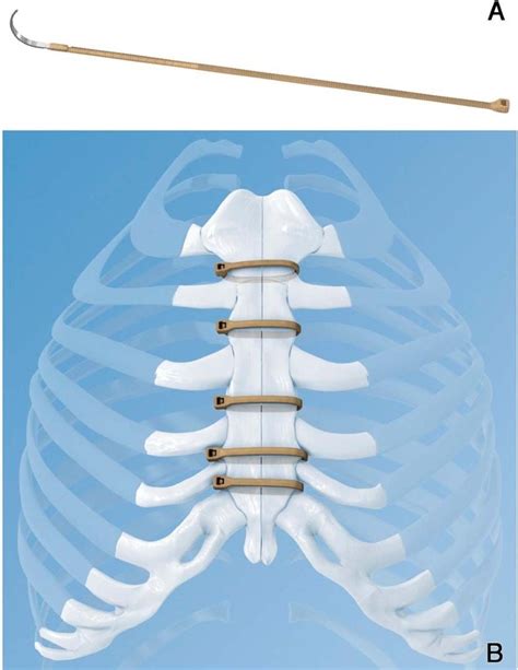 A New Cable Tie Based Sternal Closure System Description Of The Device