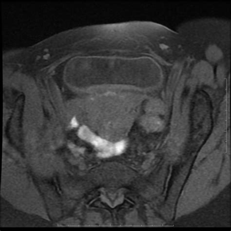 Vesicouterine Pouch Ultrasound