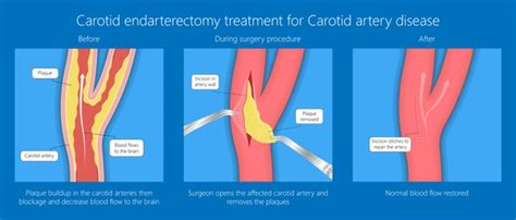 28 Carotid Artery Stenosis Stock Vectors And Vector Art Shutterstock