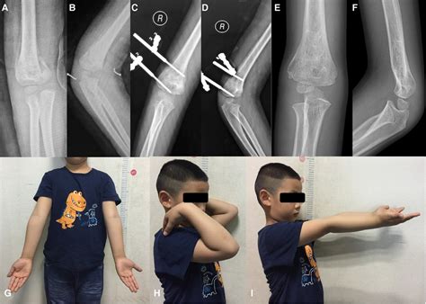 Supracondylar Humerus Fracture Treatment