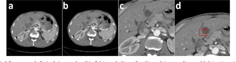 Figure 3 From Deep Learning Based Classification Of Focal Liver Lesions With 3 And 4 Phase