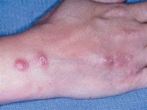Bệnh Nấm Sporotrichosis