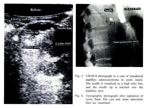 Endoscopy Biopsy Lymph Node At Douglas Byrd Blog