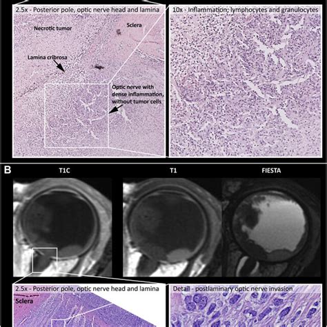The Magnetic Resonance Imaging Mri Pathological Correlations Of Download Scientific Diagram