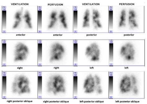 Planar V Q Scan Showing Multiple Perfusion Defects Matched With Download Scientific Diagram
