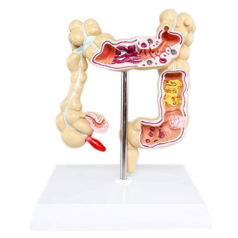 High Quality Medical Diseases Colon Model China Medical Diseases Colon Model And Stomach