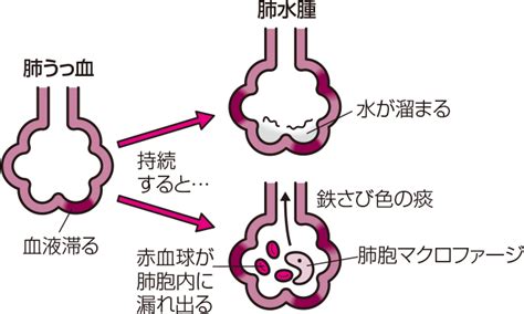 咳嗽がいそう 咳痰に関するQA 看護roo カンゴルー