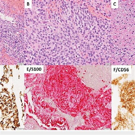Imaging Presentation And Gross Specimen Of A Patient With Primary Erms