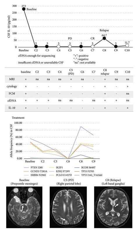 Disease Monitoring Through Csf Cfdna Csf Il 10 And Mri Of Patient