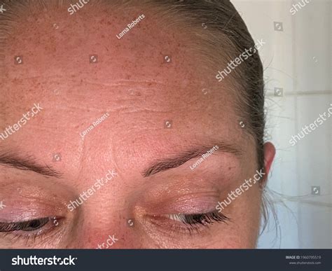 Melasma Face Woman Hyperpigmentation Rare Addisons Foto Stock 1960795519 Shutterstock