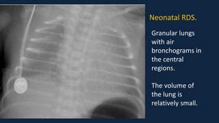 Pediatric Chest X Ray Interpretationpdf