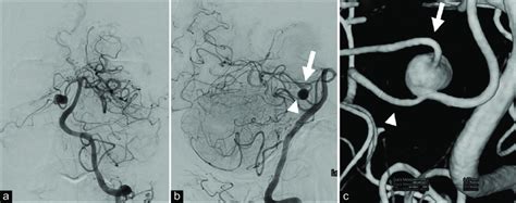 Imaging Before The Procedure Adsa Frontal View B Dsa Lateral Download Scientific Diagram Imaging Before The Procedure Adsa Frontal View B Dsa Lateral Download Scientific Diagram