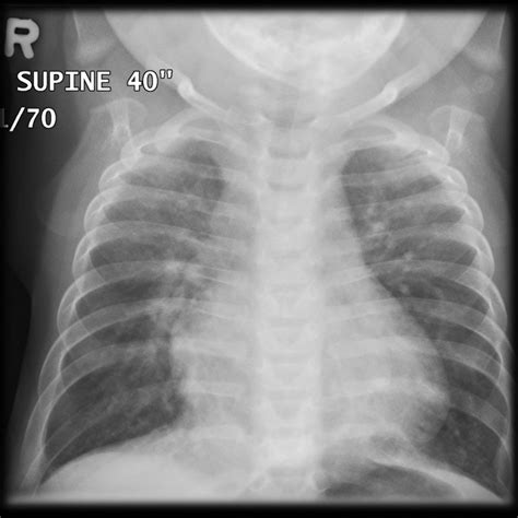 Atrioventricular Septal Defect Buyxraysonline